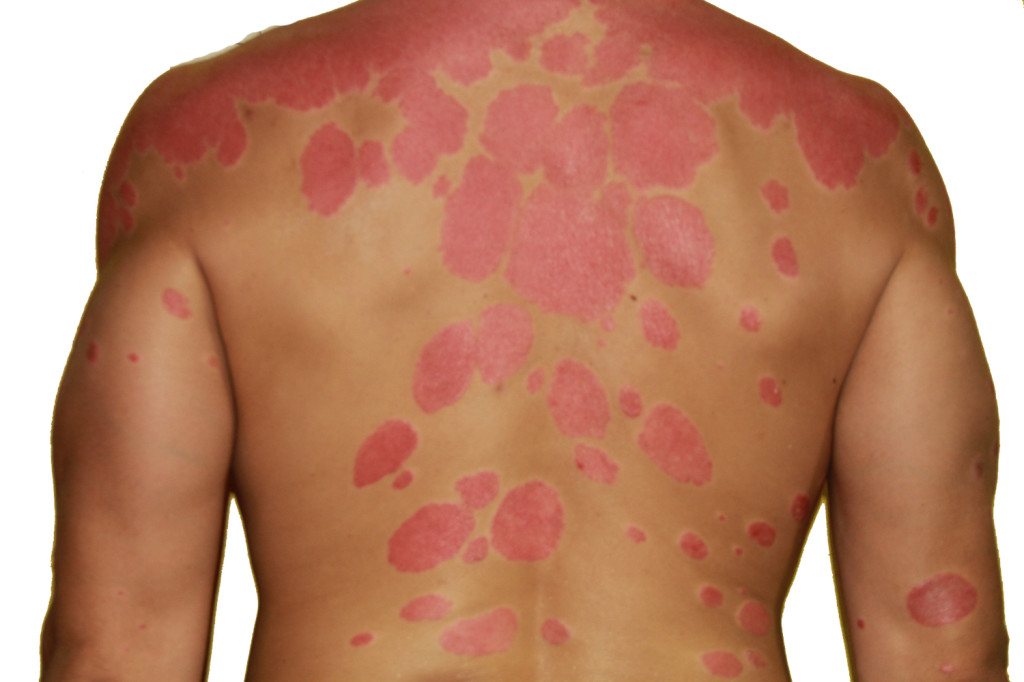 back psoriasis healing - A Warrior Curing Psoriasis Naturally