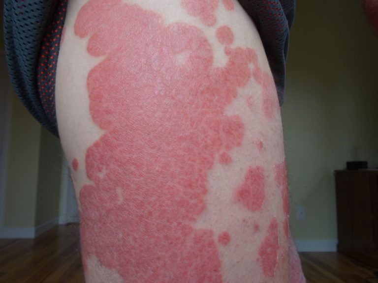 natural-healing-psoriasis-DSC01626 - A Warrior Curing Psoriasis Naturally