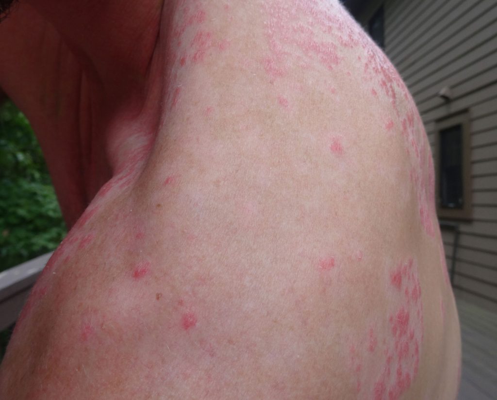 left-shoulder - A Warrior Curing Psoriasis Naturally