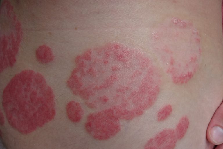 Right Hip2 A Warrior Curing Psoriasis Naturally